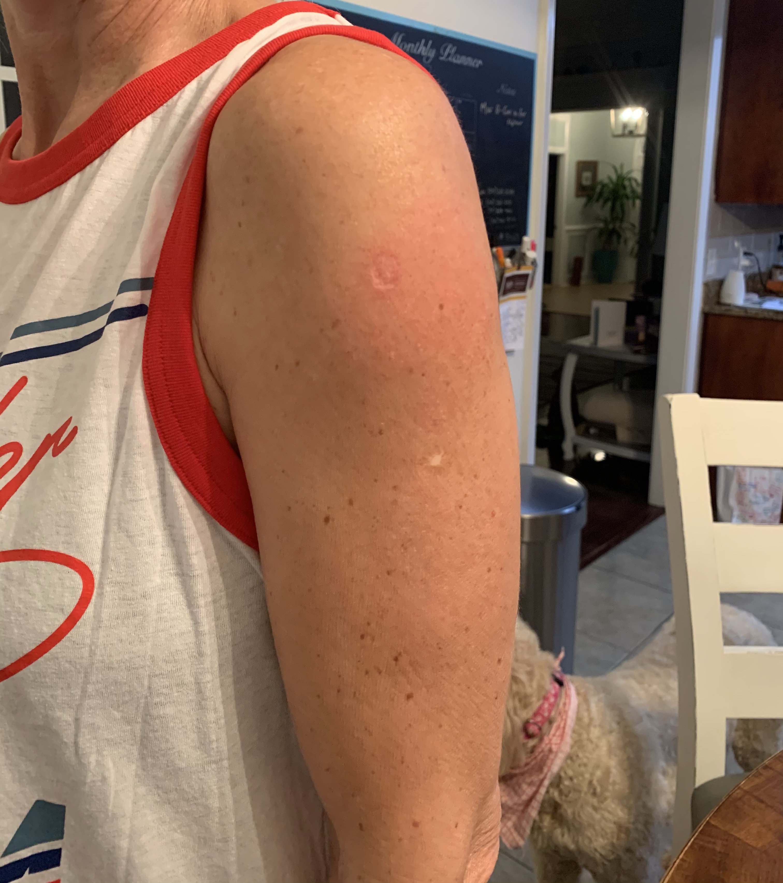 COVID-19 Moderna vaccination / Covid Arm side effect and my experience ...